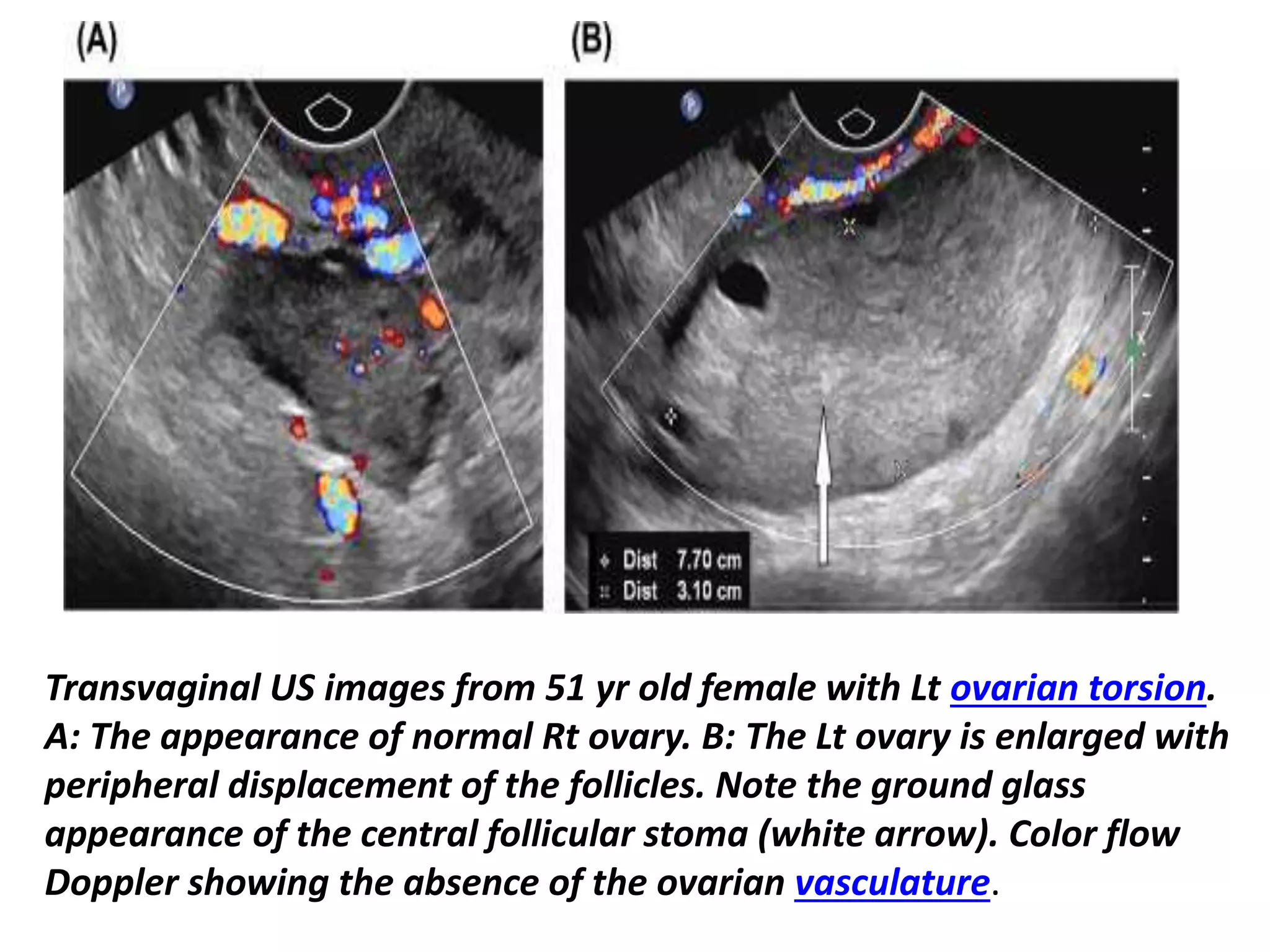 Presentation11, radiological imaging of ovarian torsion. | PPTX
