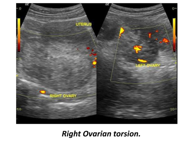 Presentation11, radiological imaging of ovarian torsion. | PPTX ...
