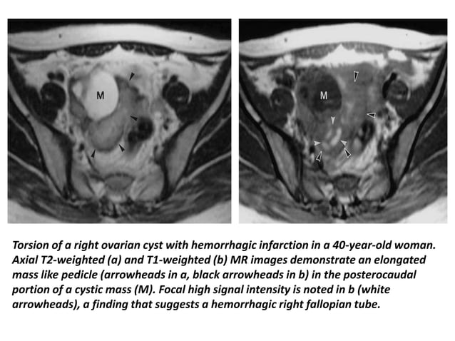 Presentation11 Radiological Imaging Of Ovarian Torsion Ppt
