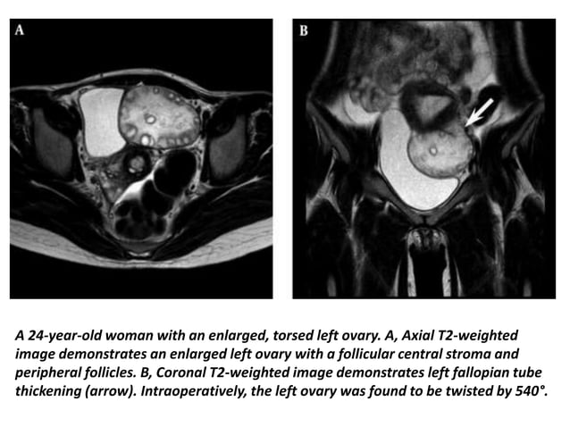 Presentation11, radiological imaging of ovarian torsion. | PPTX ...