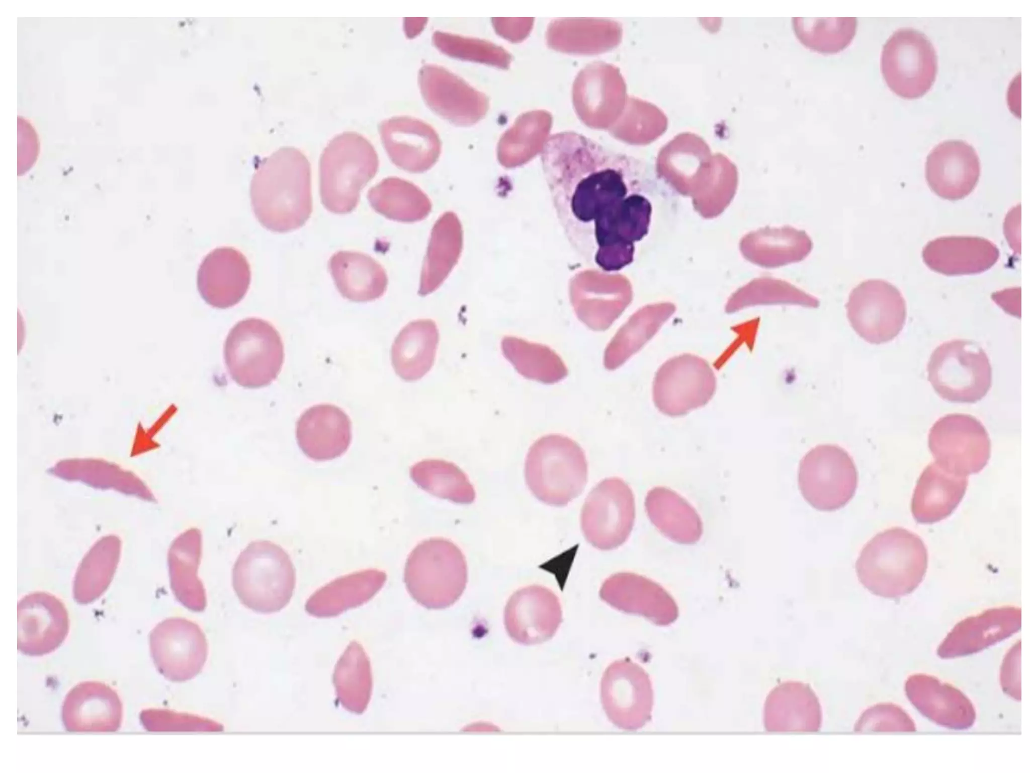 Presentation11 rao kd HAEMOGLOBIN | PPT