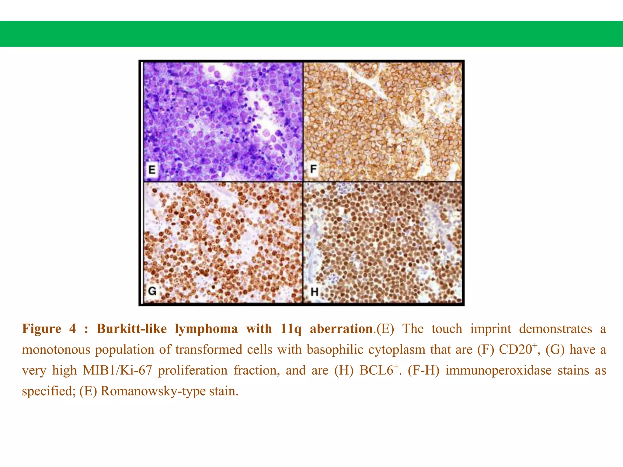 WHO 2016 update on classification of Lymphoid neoplasms | PPTX