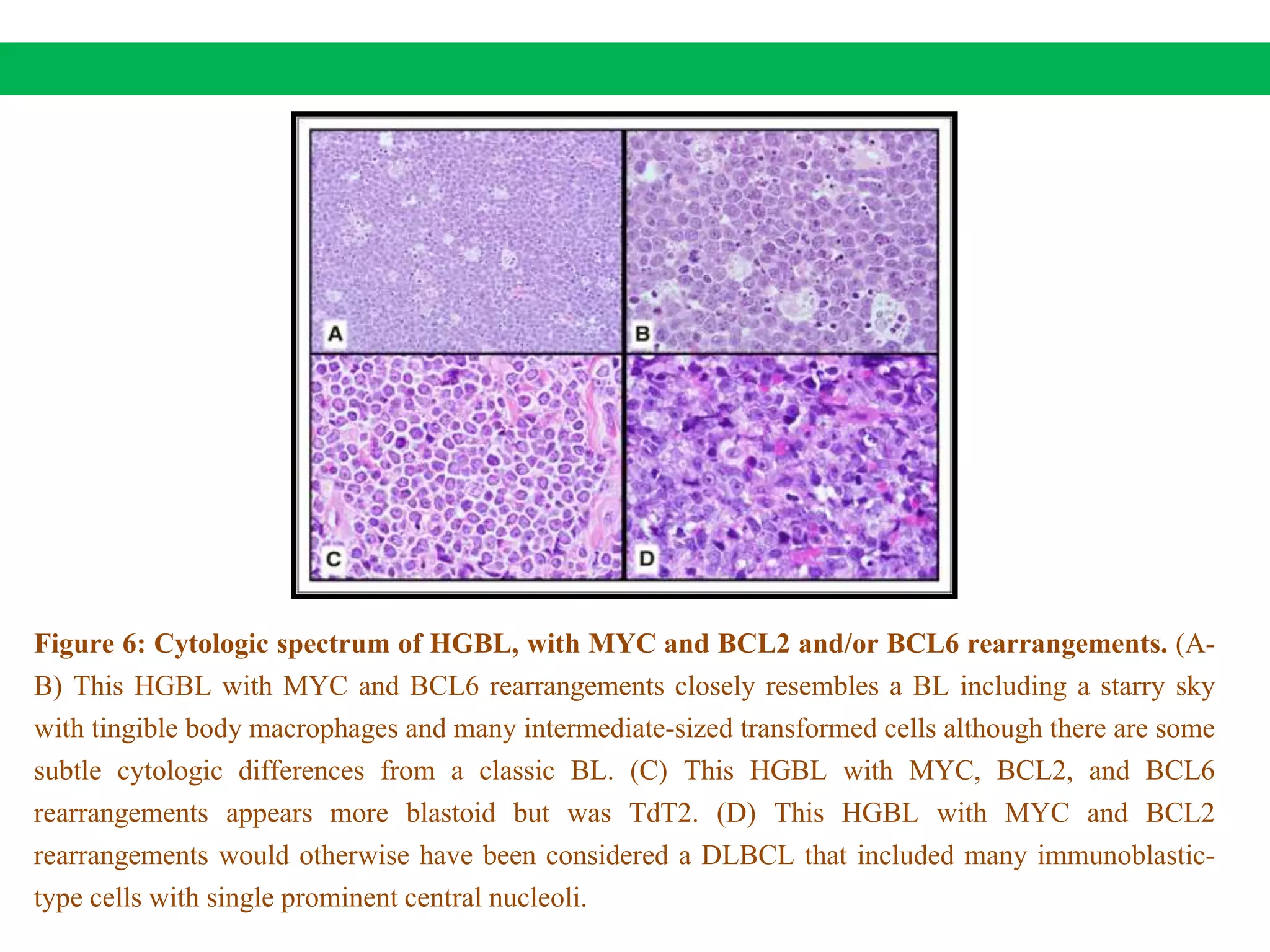 WHO 2016 update on classification of Lymphoid neoplasms | PPTX