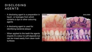 Chemical plaque control Presentation 12.pptx
