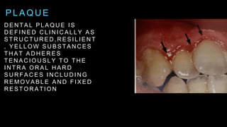 Chemical plaque control Presentation 12.pptx