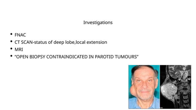 Salivary gland neoplasm surgery mbbs.pptx