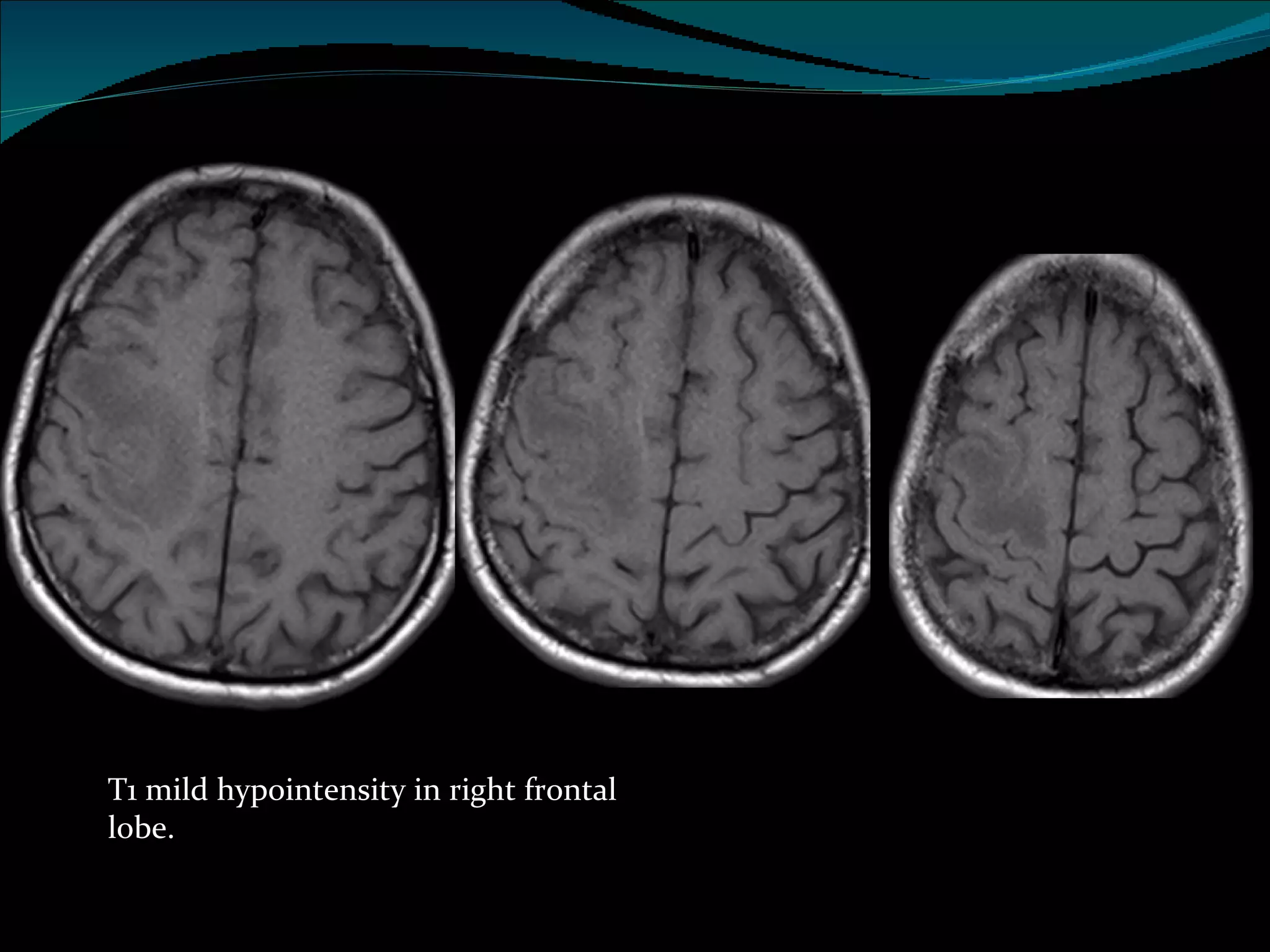 BASICS OF MRI | PPT