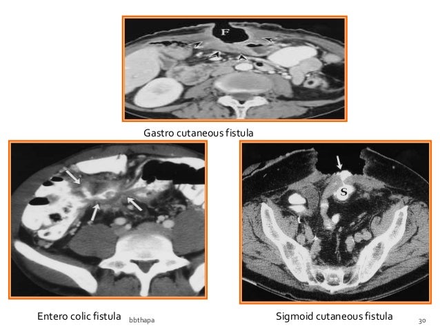 Enterocutaneous fistula