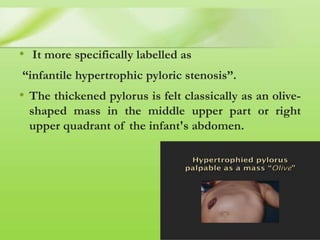 Pyloric Stenosis Olive Shaped Mass