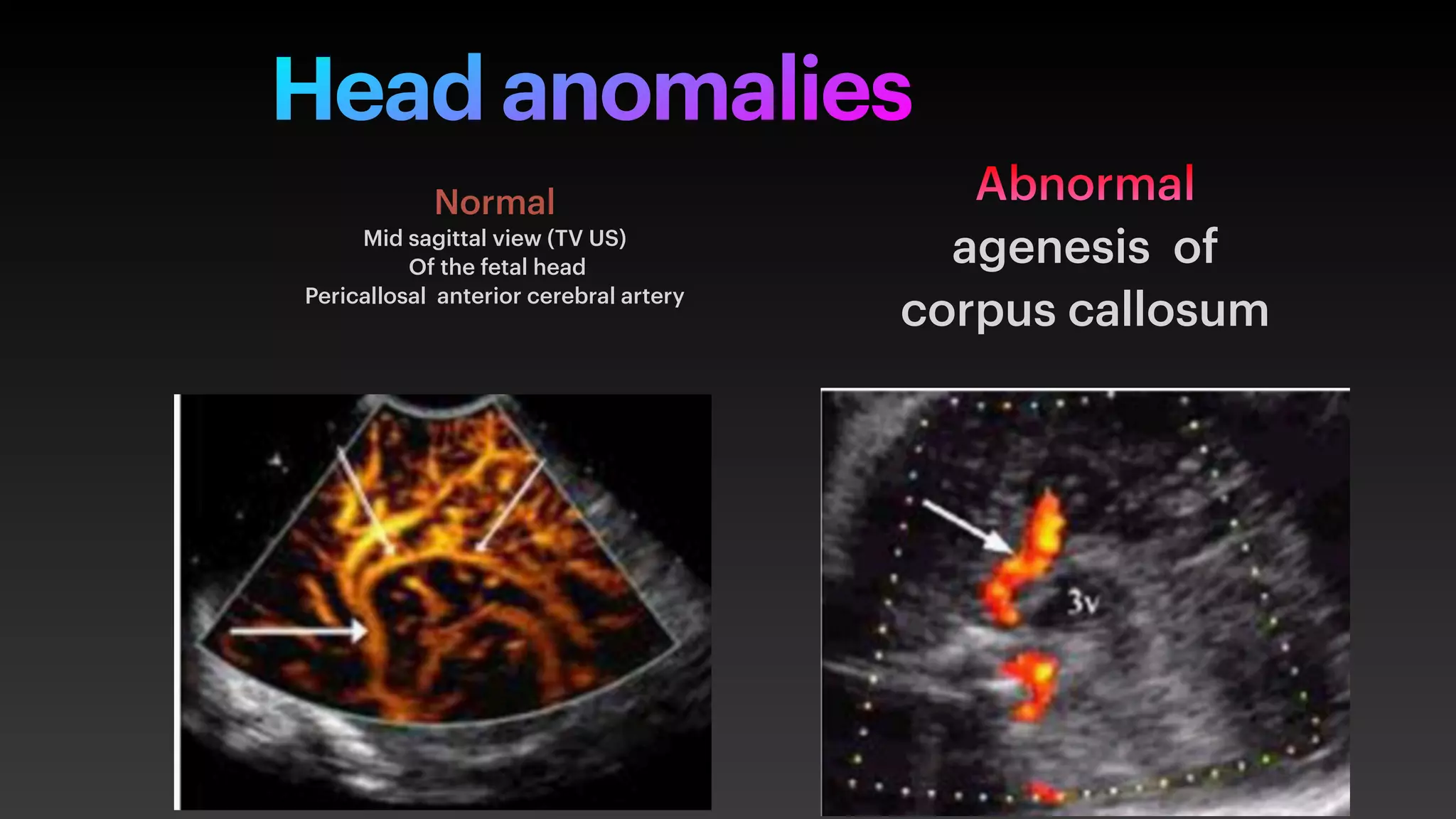 Presentation 13 doppler in fetal anomalies.pdf