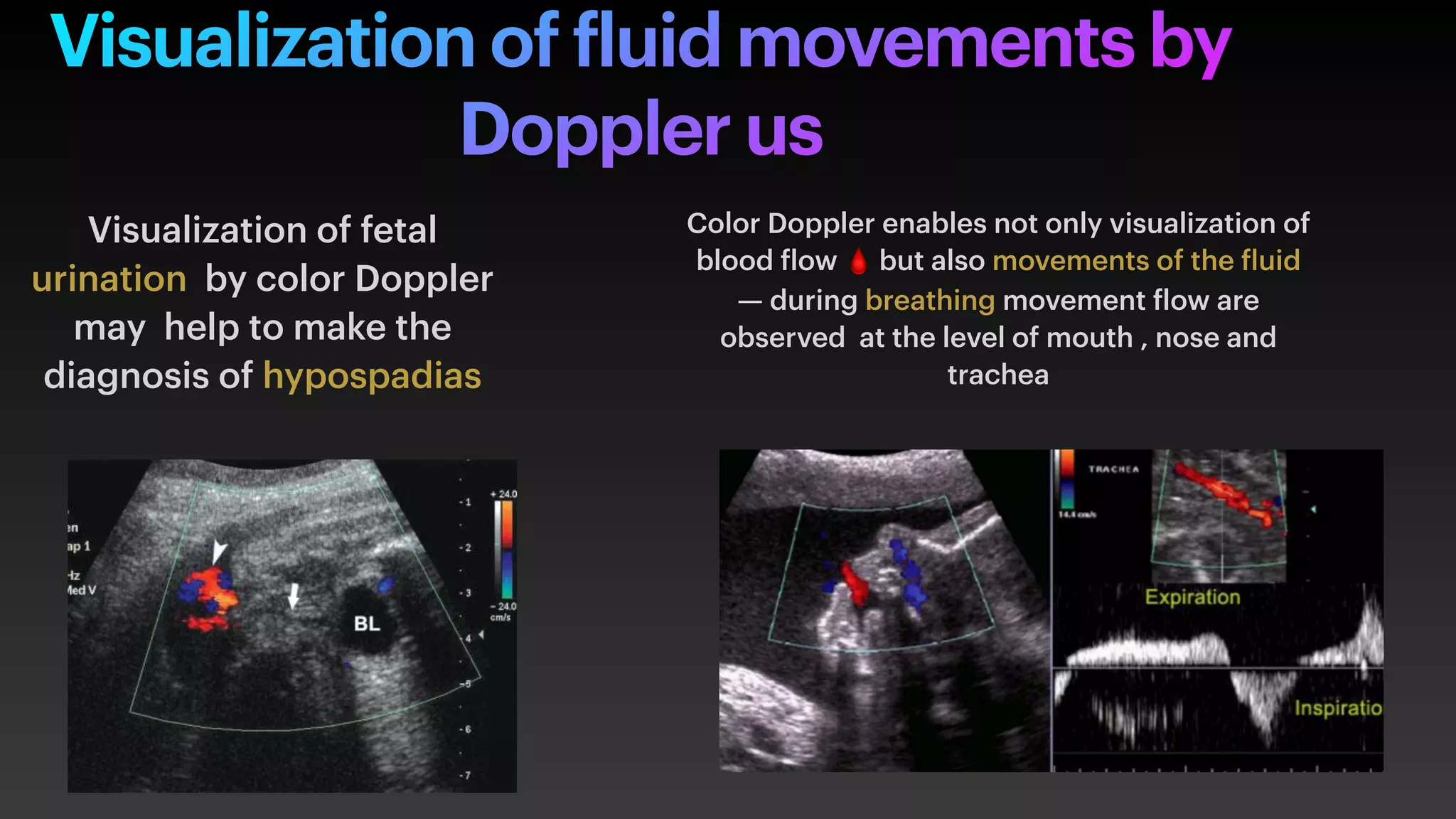 Presentation 13 doppler in fetal anomalies.pdf