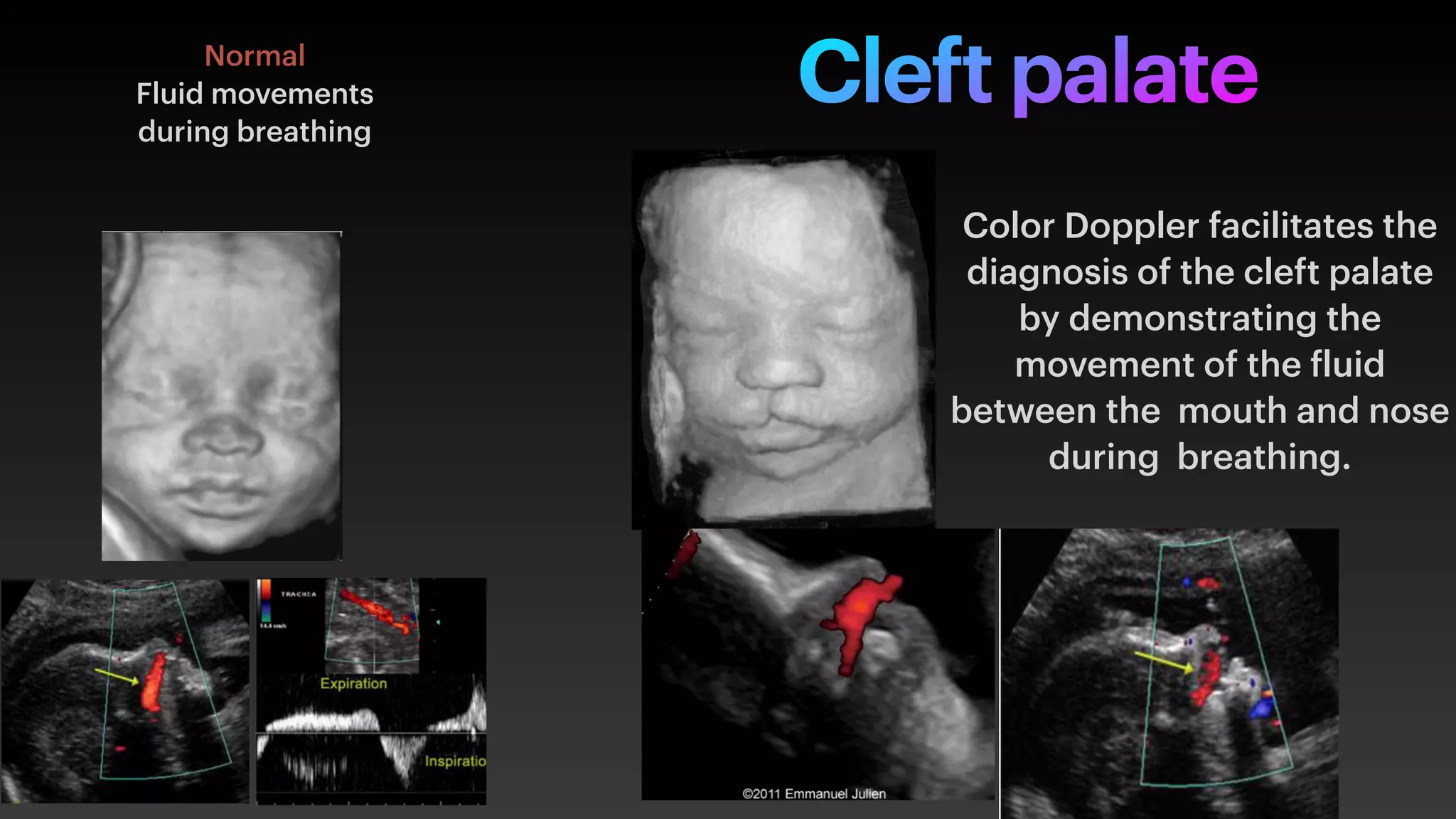 Presentation 13 doppler in fetal anomalies.pdf