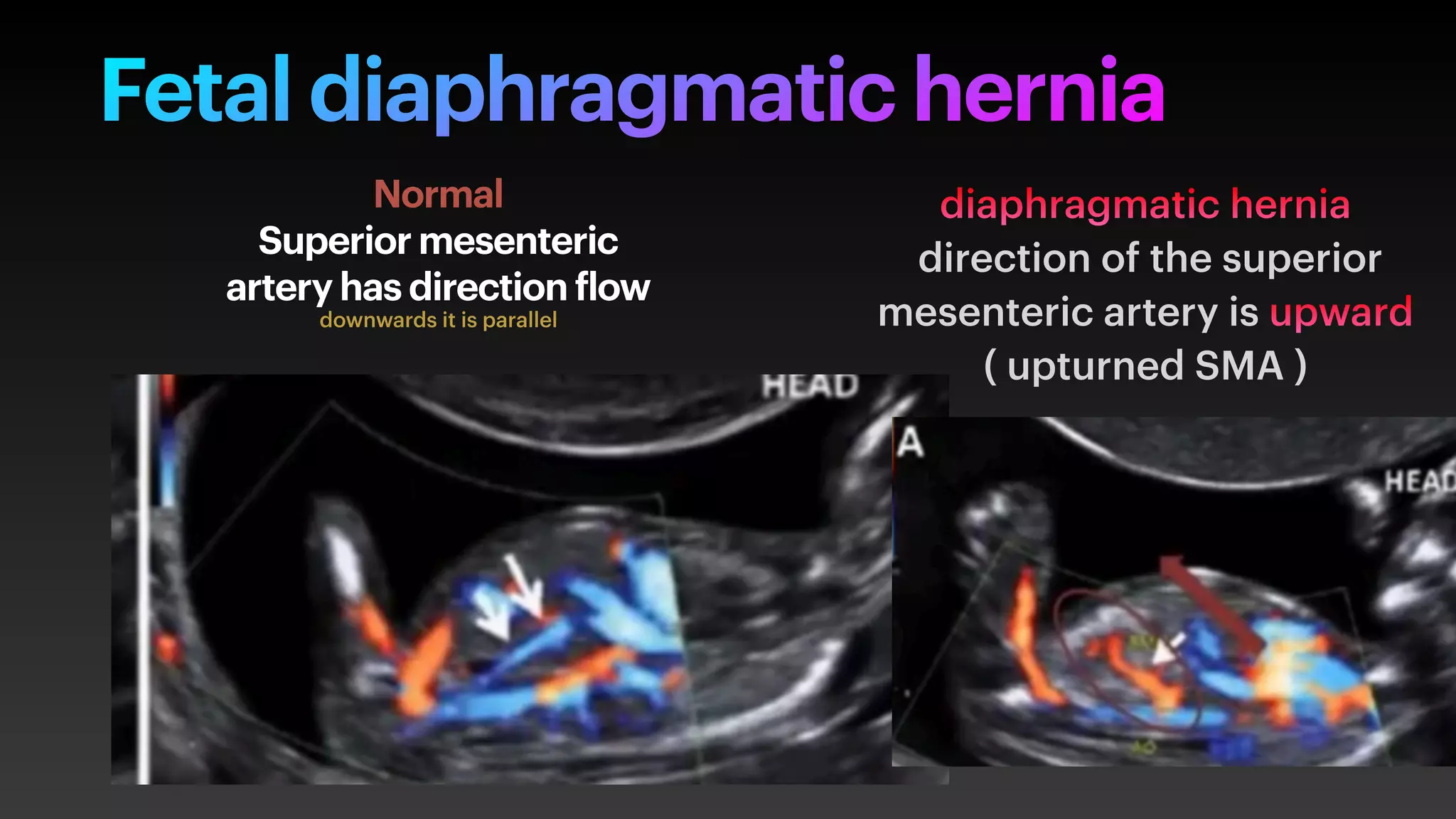 Presentation 13 doppler in fetal anomalies.pdf