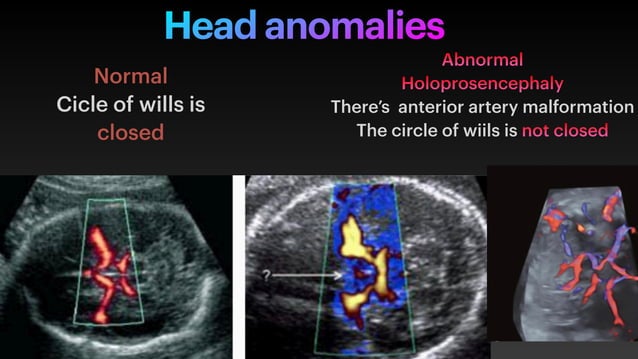 Presentation 13 doppler in fetal anomalies.pdf