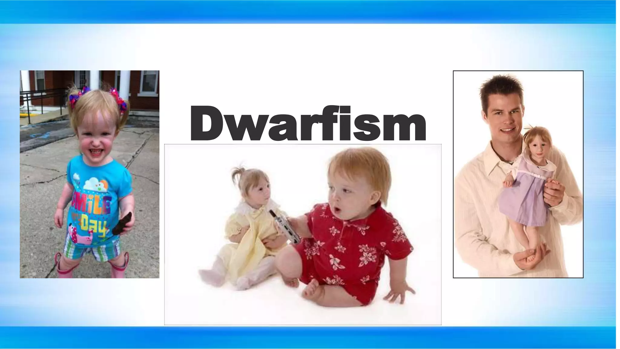 Dwarfism | PPTX