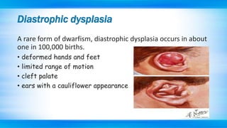 Dwarfism | PPTX