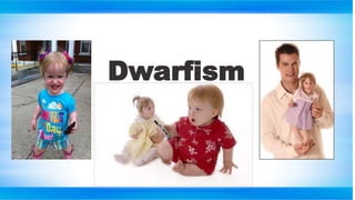 Proportionate Vs Disproportionate Dwarfism