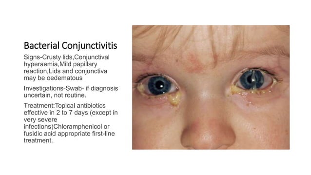 APPROACH TO RED EYE -DIAGNOSIS AND TREATMENT | PPTX | Eye and Vision ...