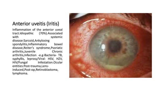 APPROACH TO RED EYE -DIAGNOSIS AND TREATMENT | PPTX | Eye and Vision ...