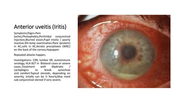 APPROACH TO RED EYE -DIAGNOSIS AND TREATMENT | PPT