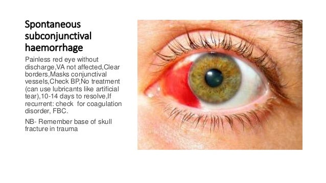 APPROACH TO RED EYE -DIAGNOSIS AND TREATMENT