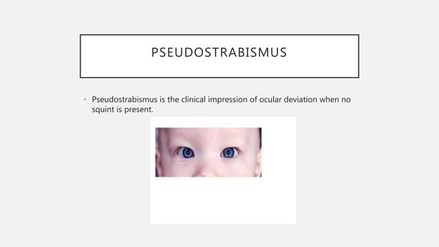 strabismus | PPTX | Ear, Nose and Throat Conditions | Diseases and Conditions