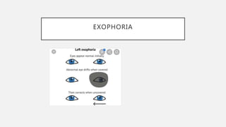 strabismus | PPTX | Ear, Nose and Throat Conditions | Diseases and ...