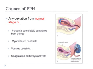 Post Partum Hemorrhage (PPH) | PPT