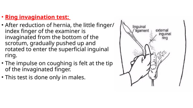 inguinal hernia and surgical managment .pptx