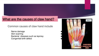 claw hand | PDF
