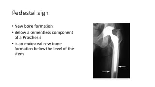 Pedestal sign | PPTX | Bone and Joint Conditions | Diseases and Conditions