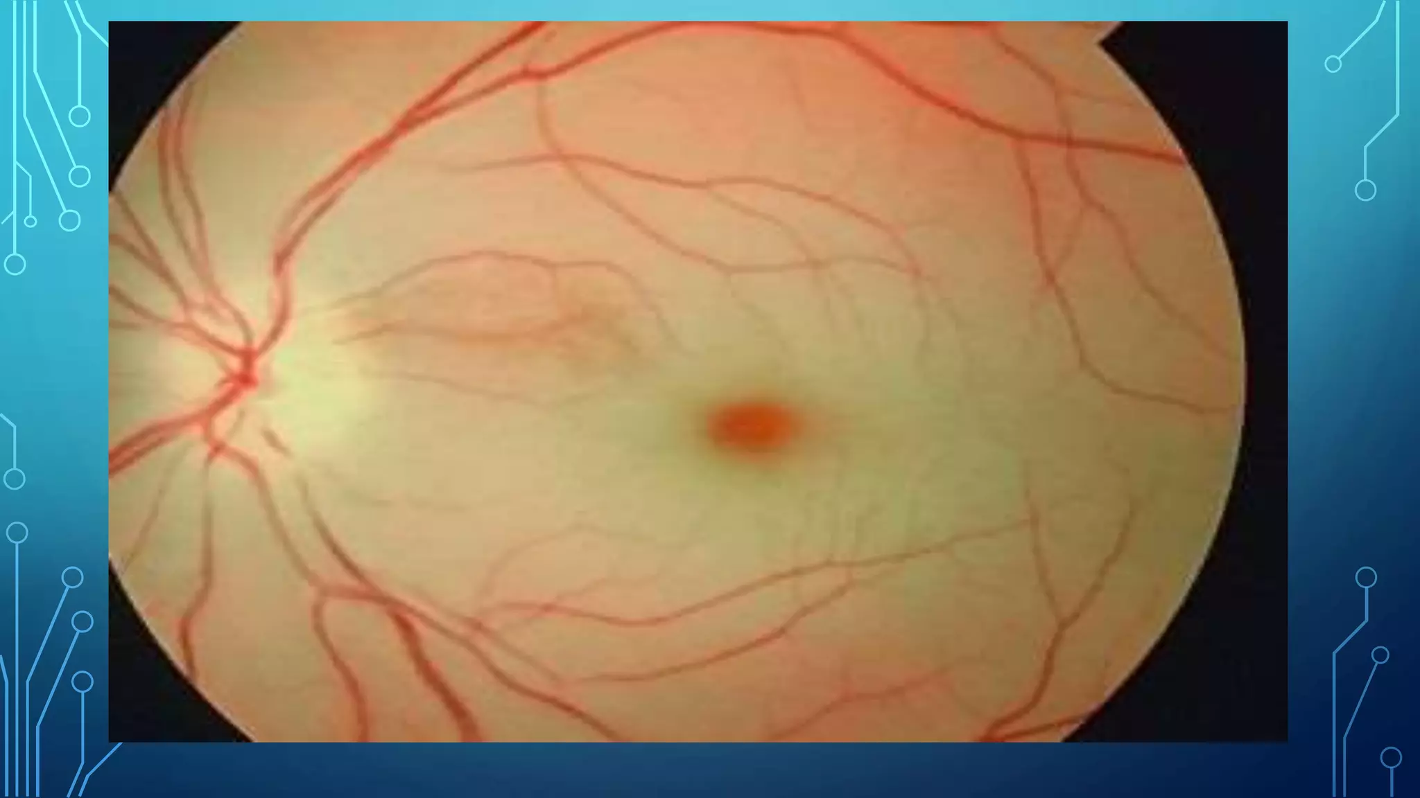 vascular occlusion of retina.pptx | Free Download