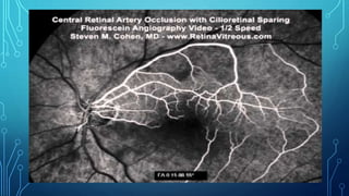 vascular occlusion of retina.pptx