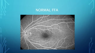 vascular occlusion of retina.pptx