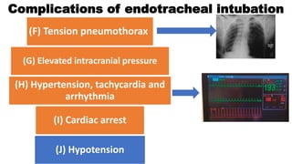 Postintubation cardiovascular collapse | PPTX