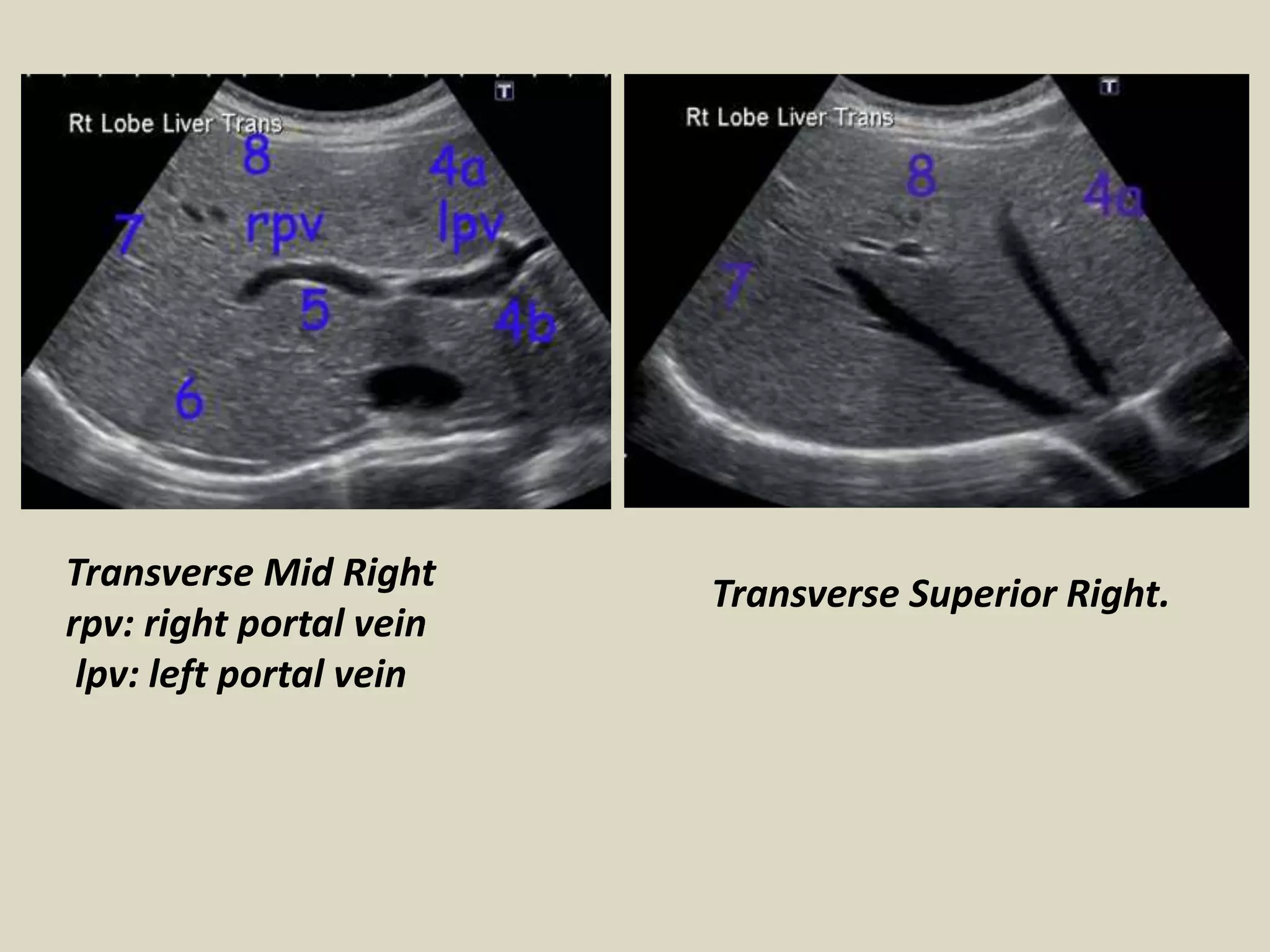 Presentation1, abdominal ultrasound anatomy. | PPTX