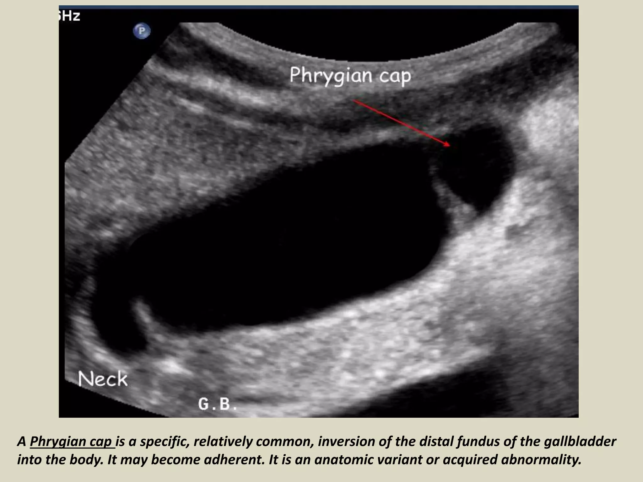 Presentation1, abdominal ultrasound anatomy. | PPTX