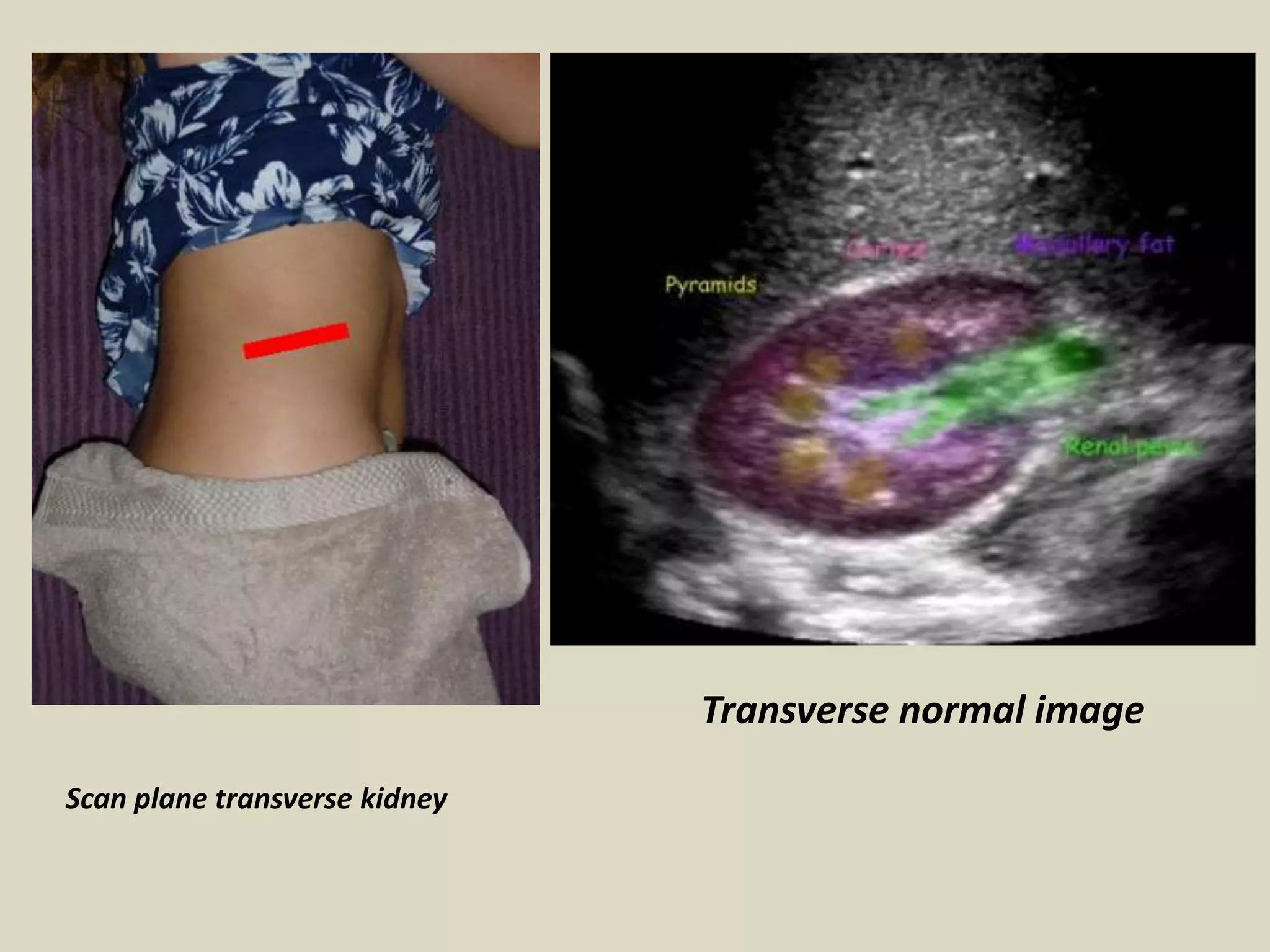 Presentation1, abdominal ultrasound anatomy. | PPTX