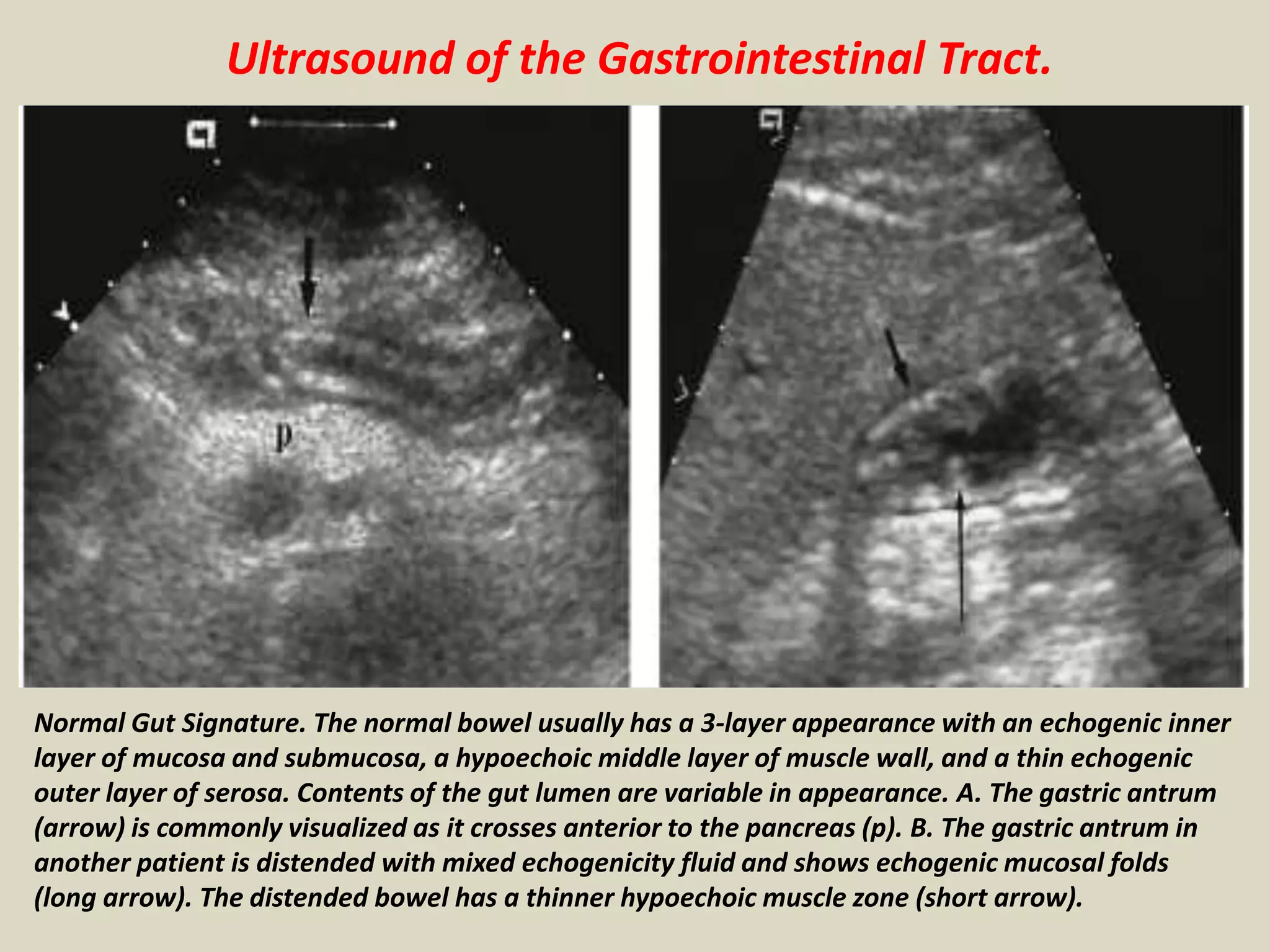 Presentation1, abdominal ultrasound anatomy. | PPTX