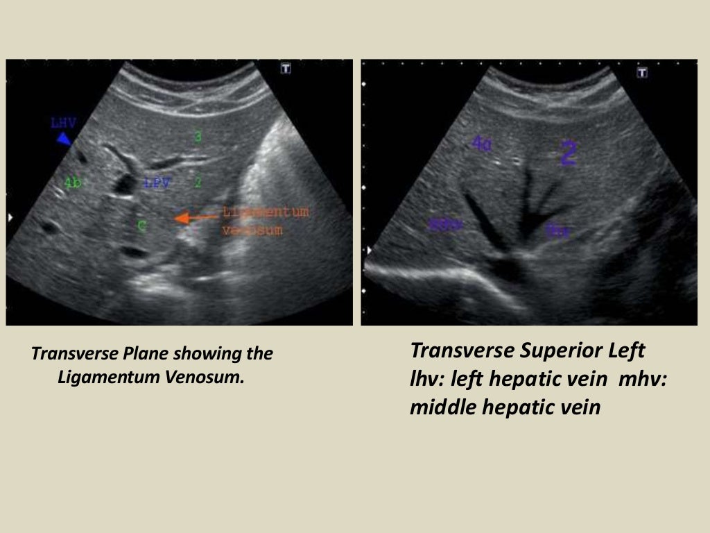 Labeled Abdominal Ultrasound Images at Brandon Myers blog