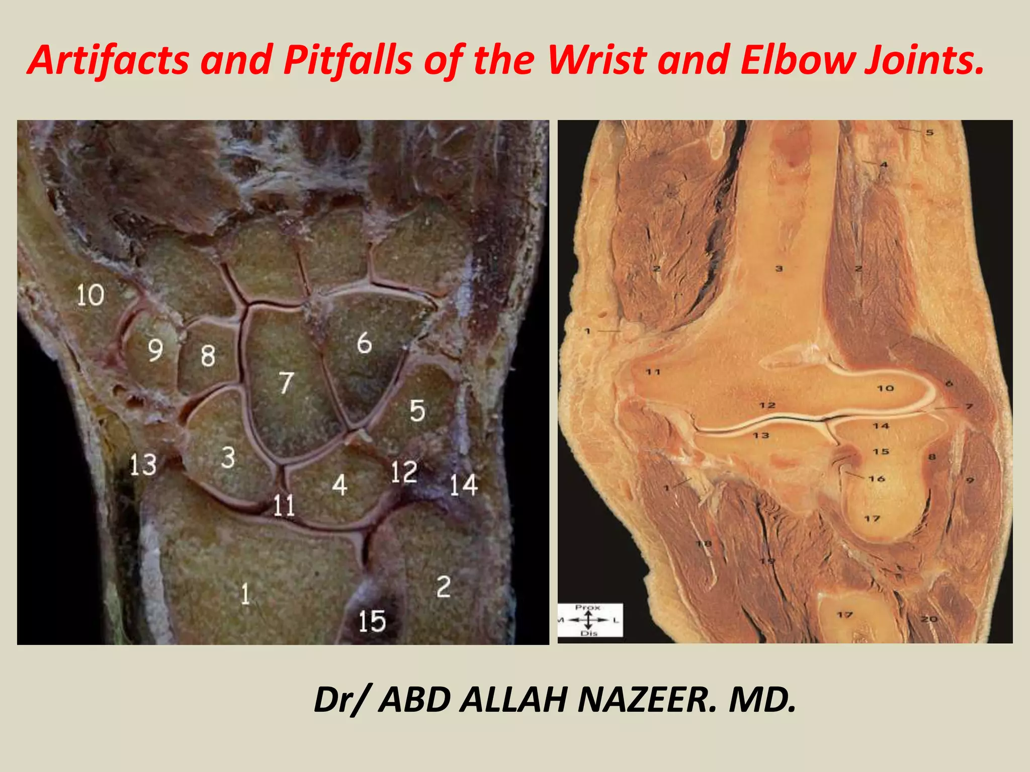 Presentation1, artifacts and pitfalls of the wrist and elbow joints. | PPTX
