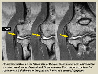 Presentation1, artifacts and pitfalls of the wrist and elbow joints. | PPT