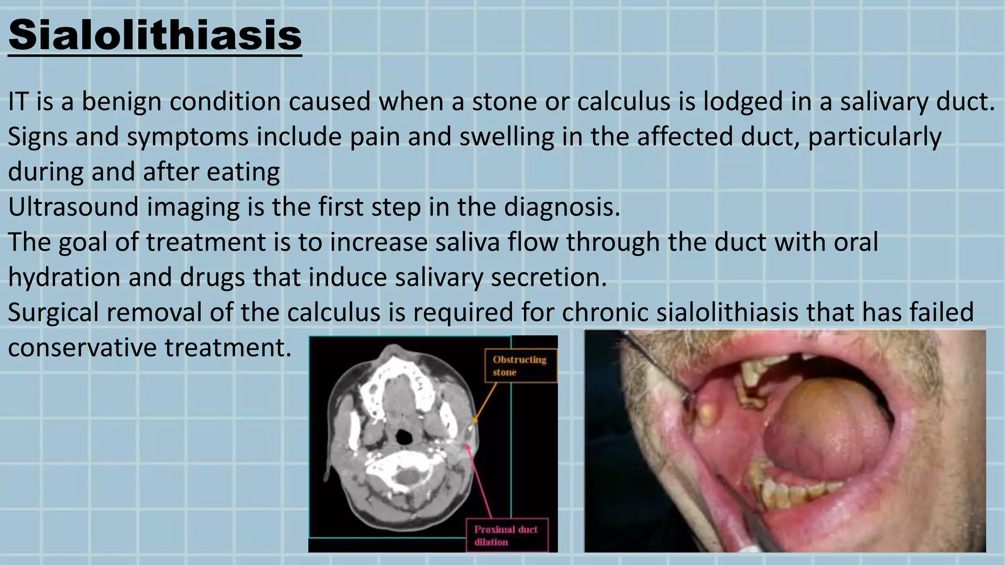 Parotid Gland | PPTX