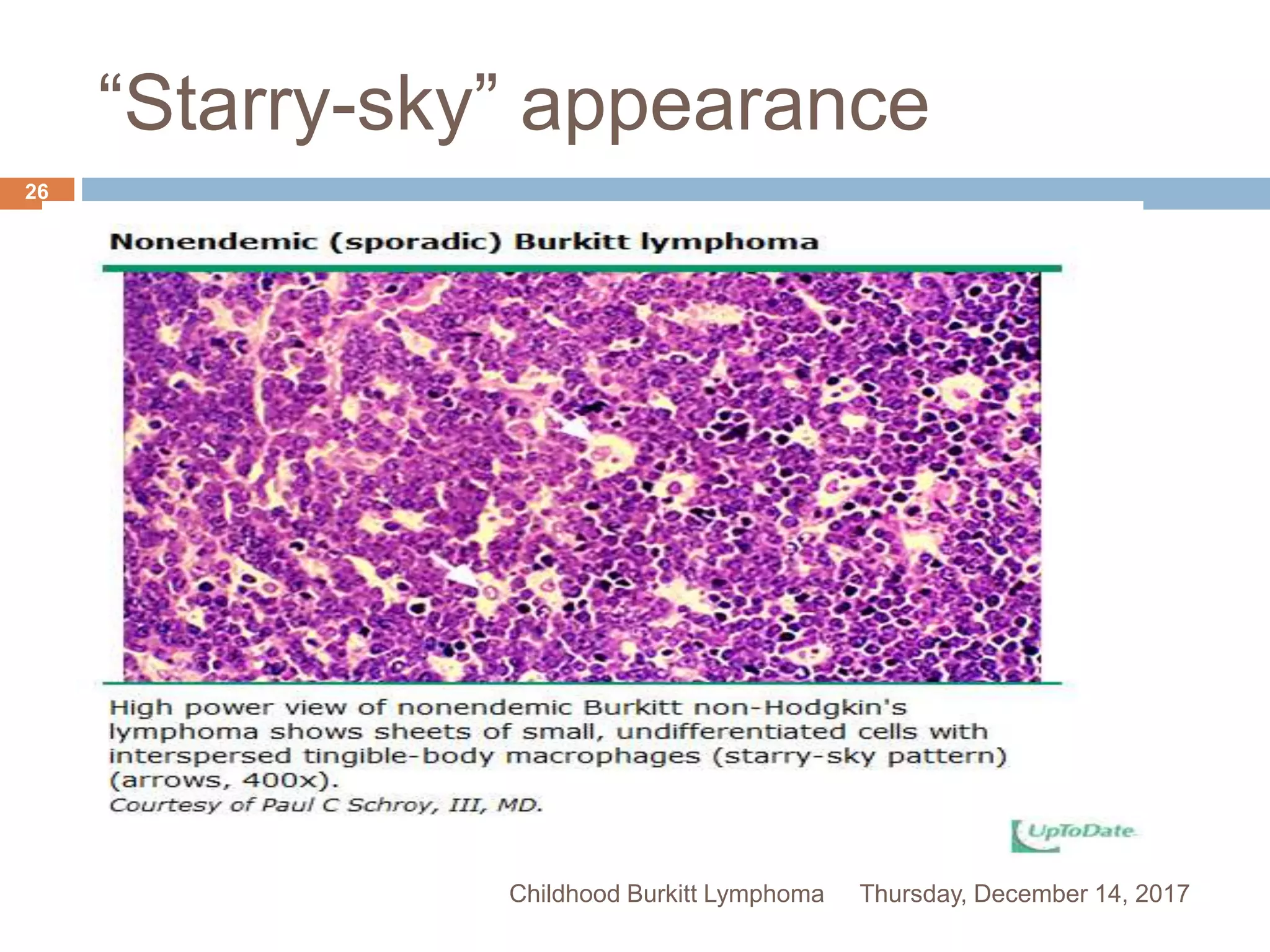 BURKITTS LYMPHOMA | PPTX