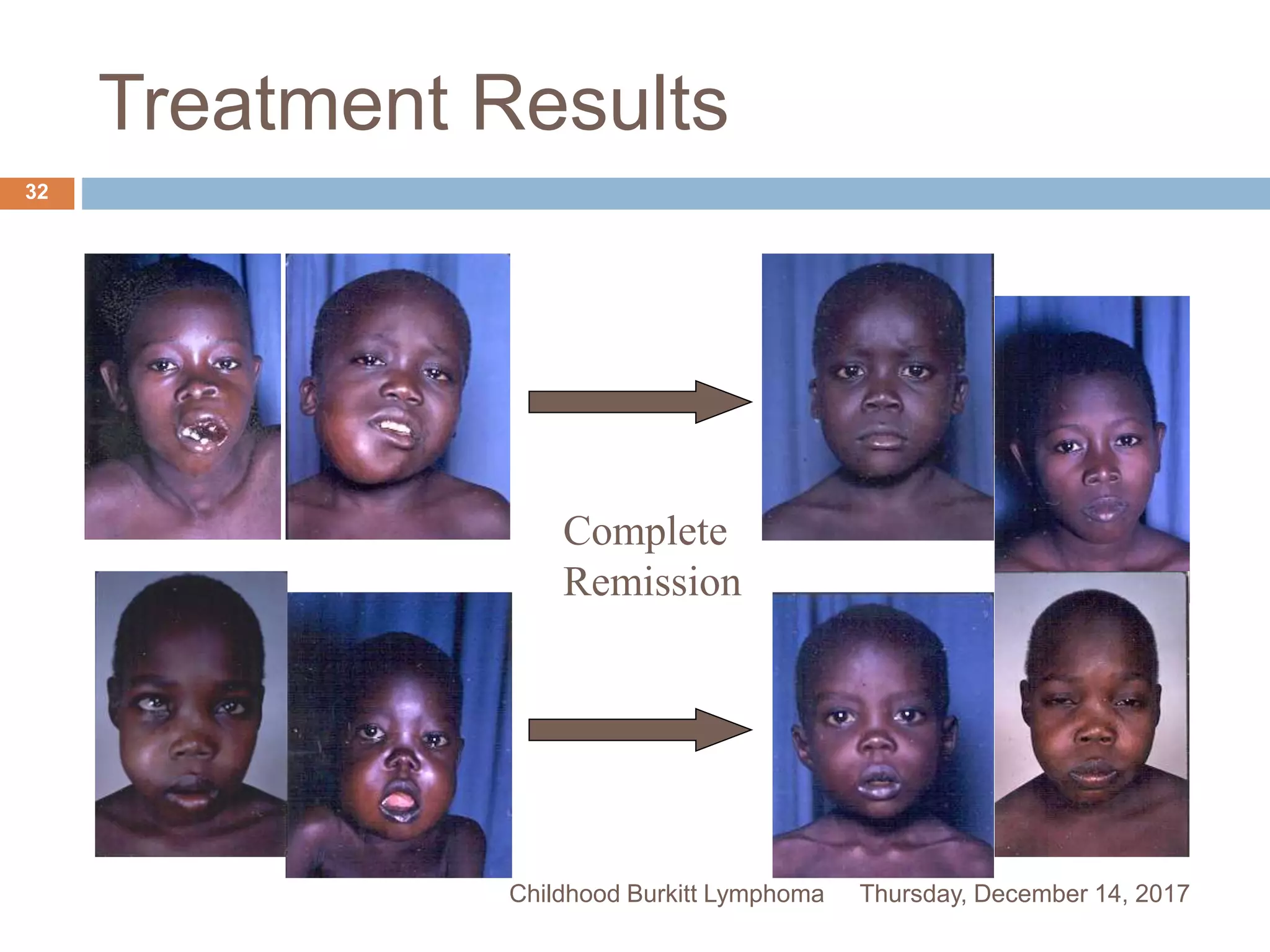 BURKITTS LYMPHOMA | PPTX