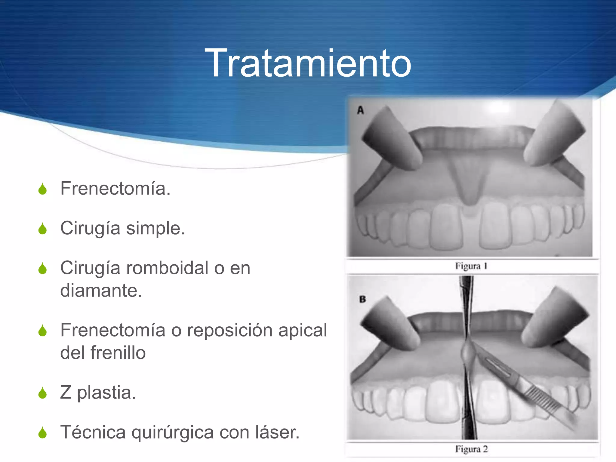 Cirugia Estetica Gingival | PPT