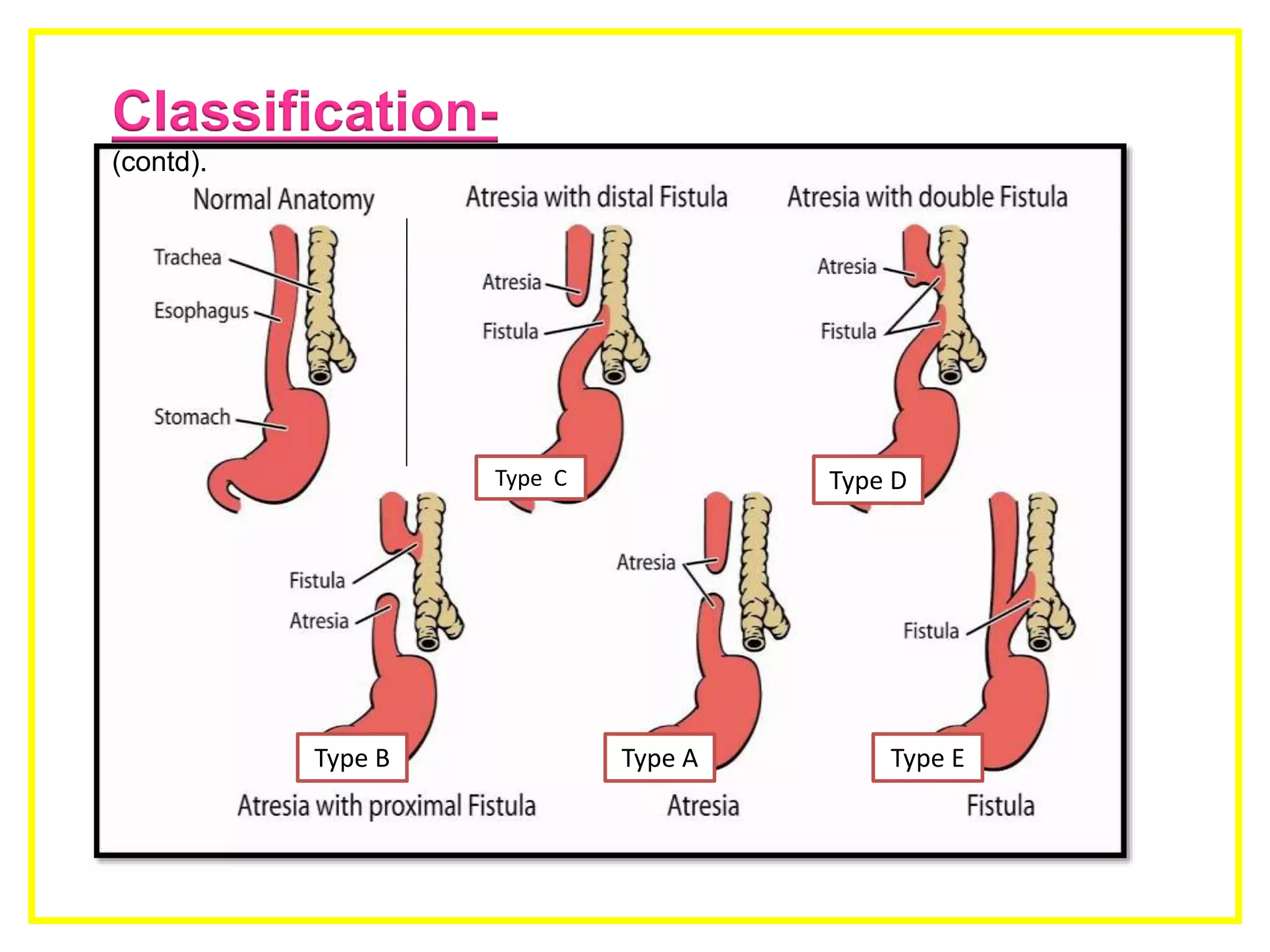 Presentation on esophageal atresia and tracheoesophageal fistula | PPTX