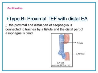 Presentation on esophageal atresia and tracheoesophageal fistula | PPTX