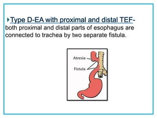 Proximal Vs Distal Esophagus