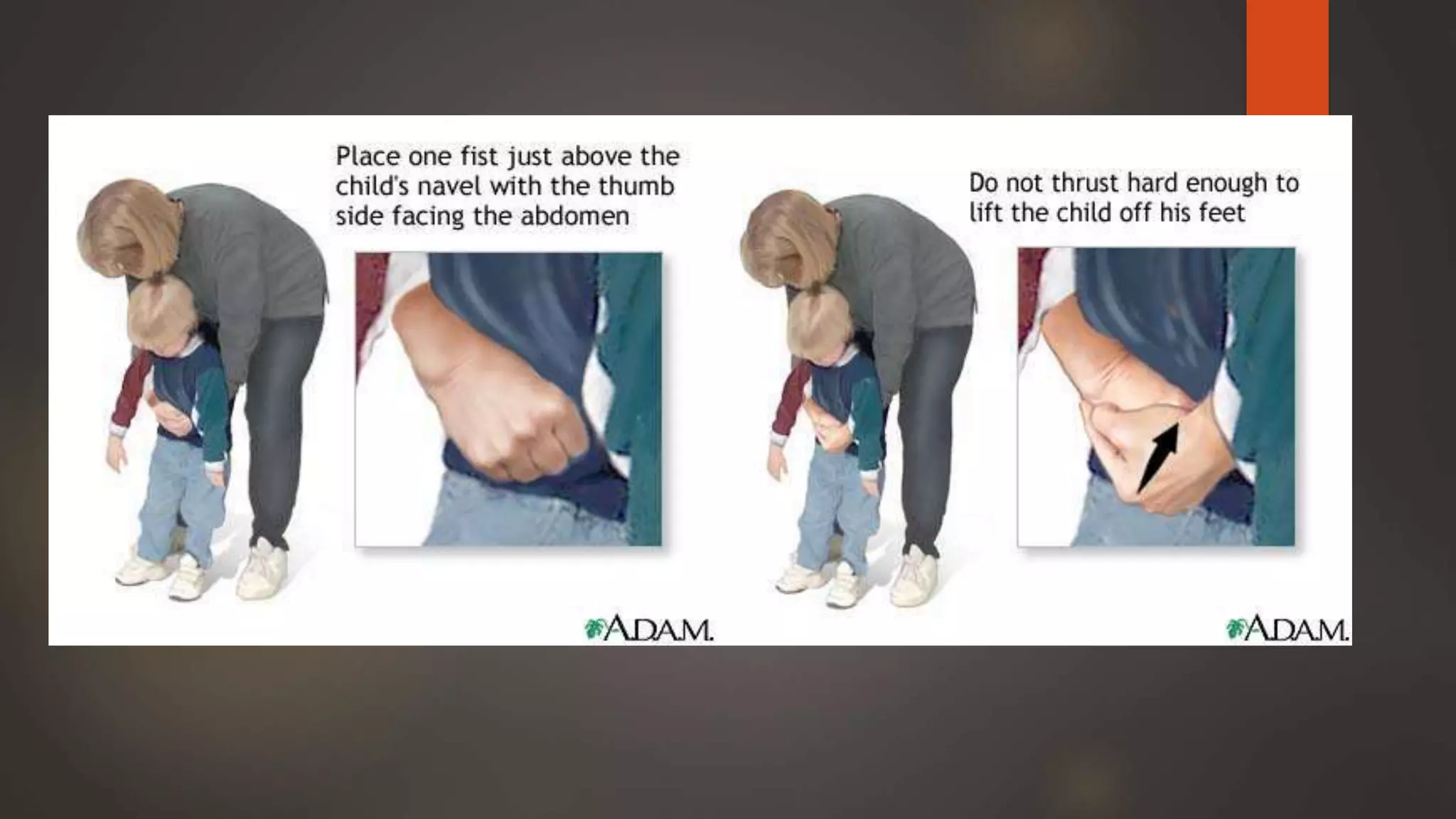 Foreign body aspiration in children | PPTX